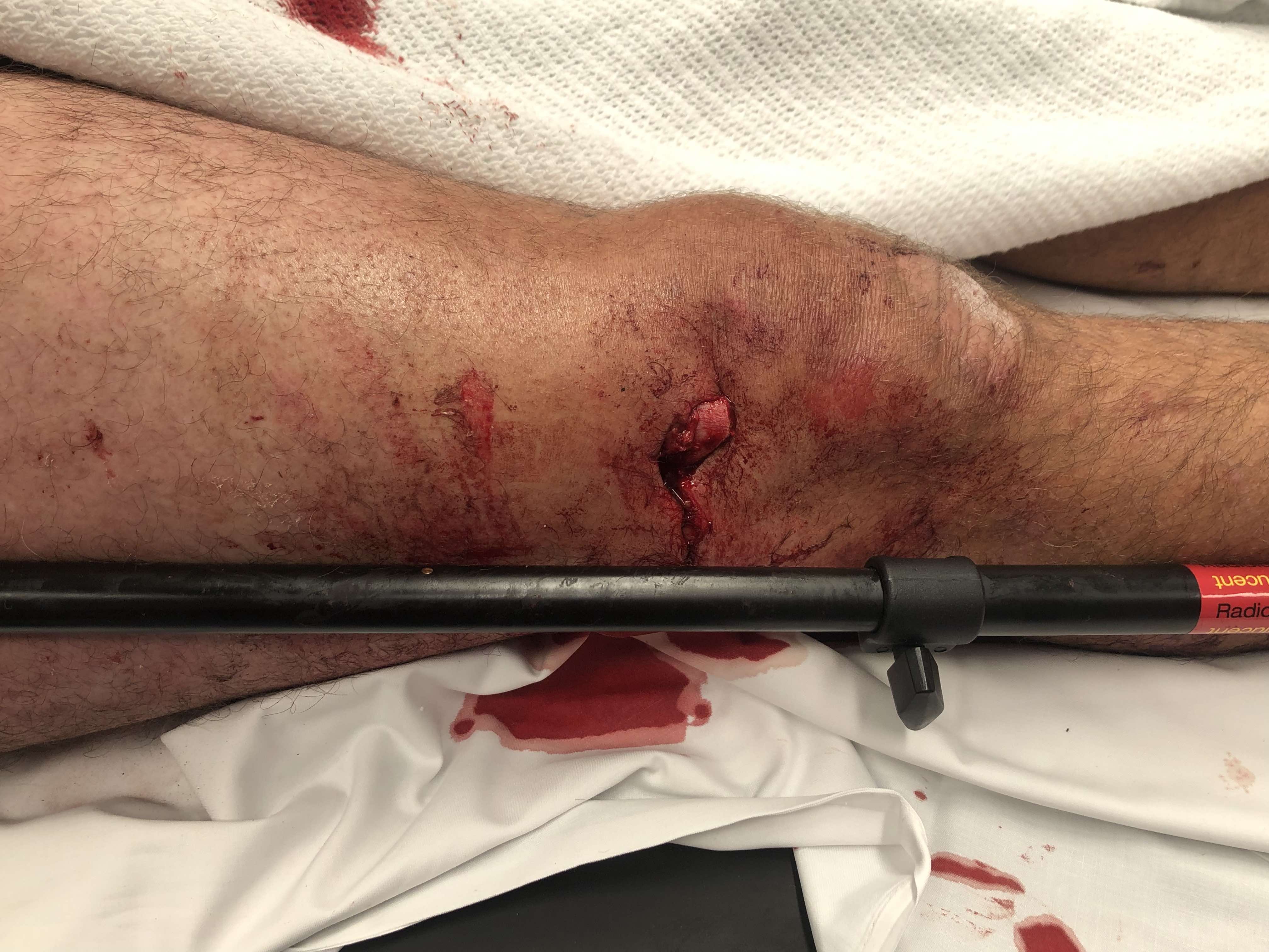 Femoral Shaft Fractures | The Bone School