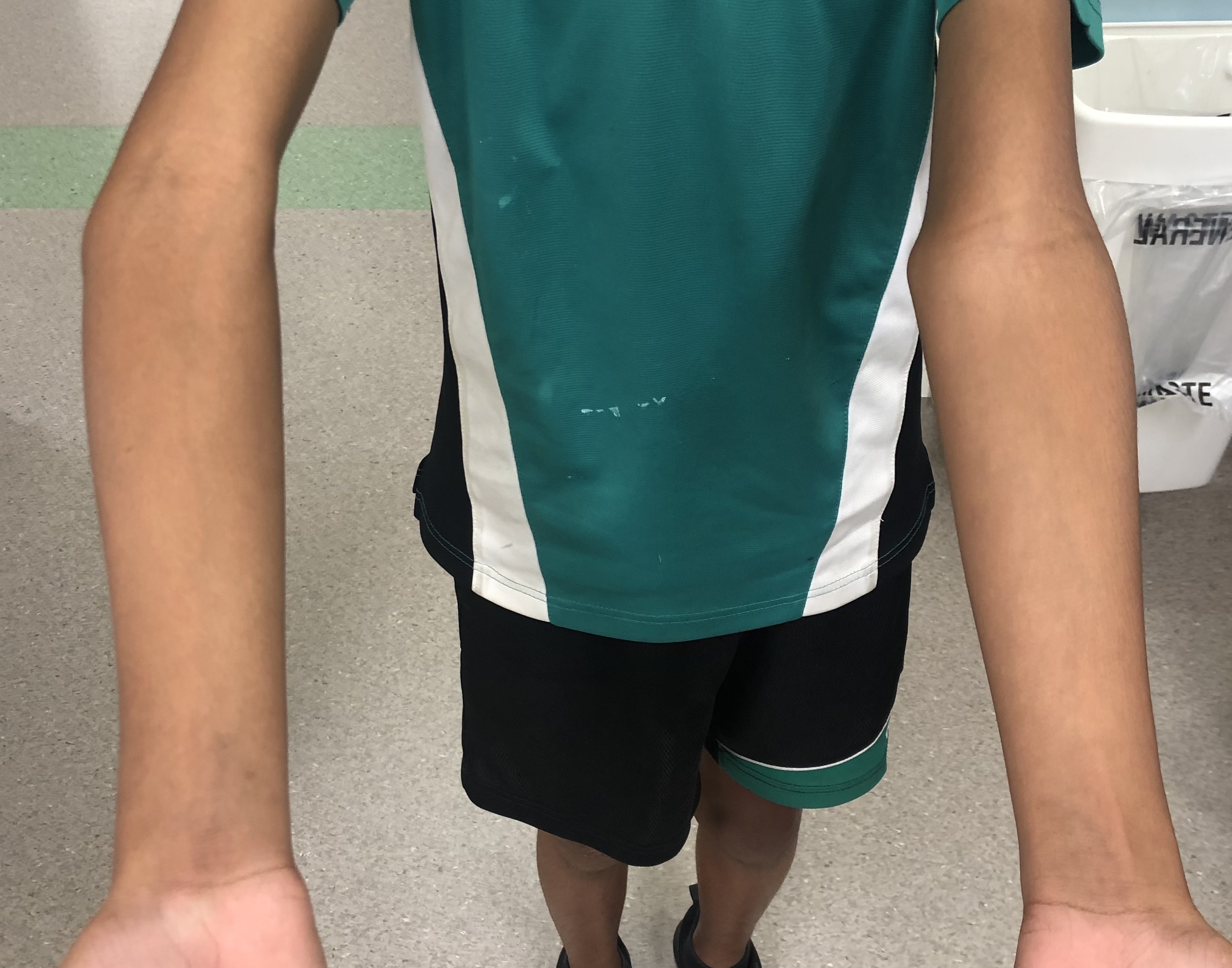 Supracondylar fractures | The Bone School
