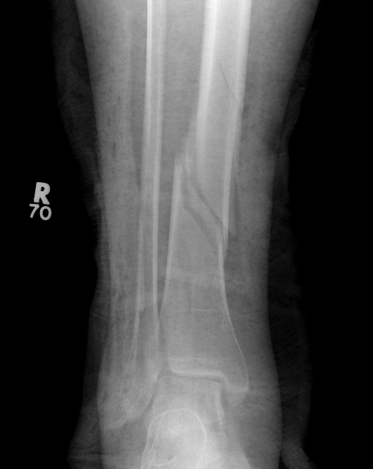 Distal Tibial Fractures | The Bone School