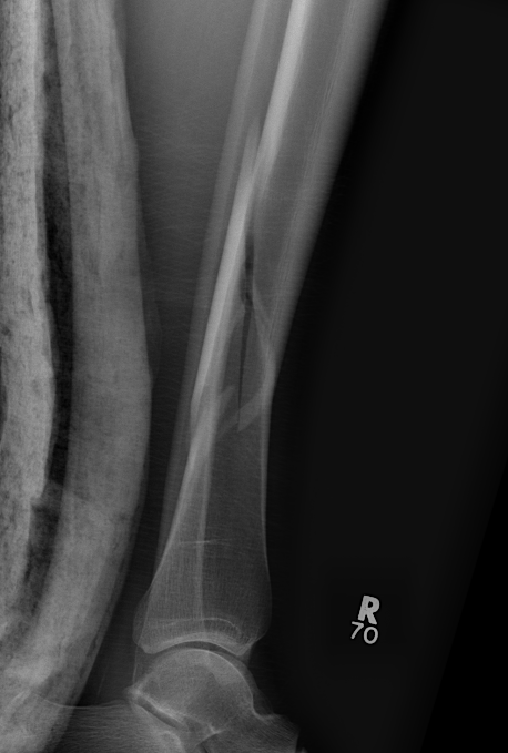 Distal Tibial Fractures | The Bone School