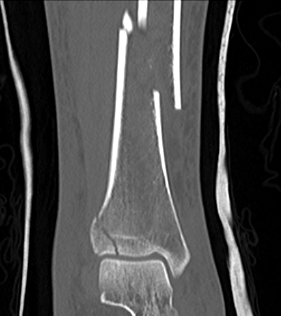 Distal Tibial Fractures | The Bone School
