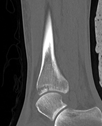 Distal Tibial Fractures | The Bone School