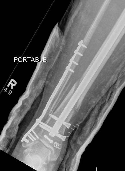 Distal Tibial Fractures | The Bone School