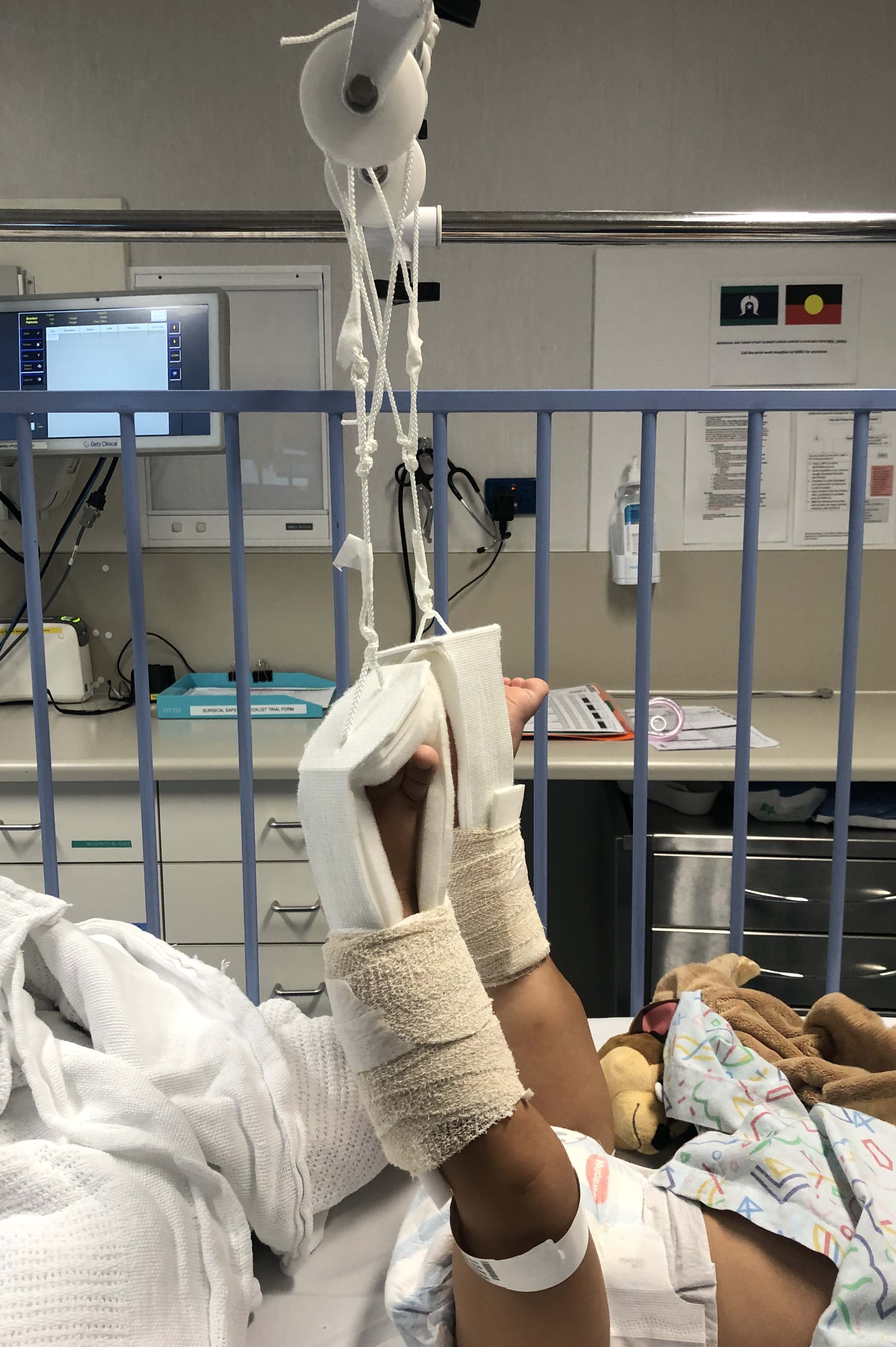 Femoral Fractures | The Bone School