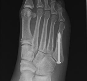 Metatarsal Fractures | The Bone School