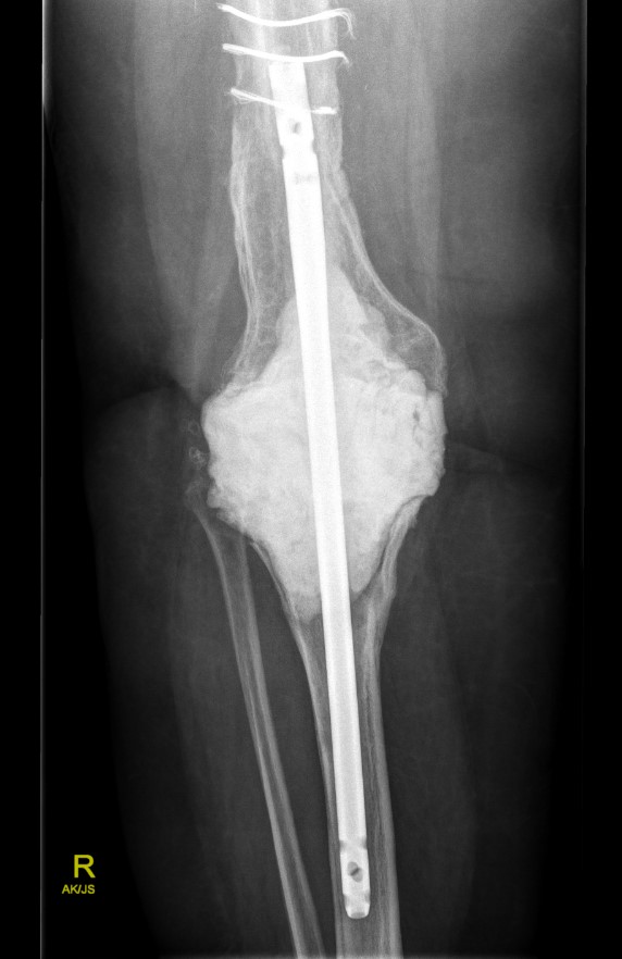 Arthrodesis | The Bone School