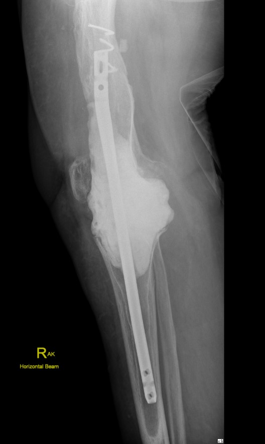 Arthrodesis | The Bone School