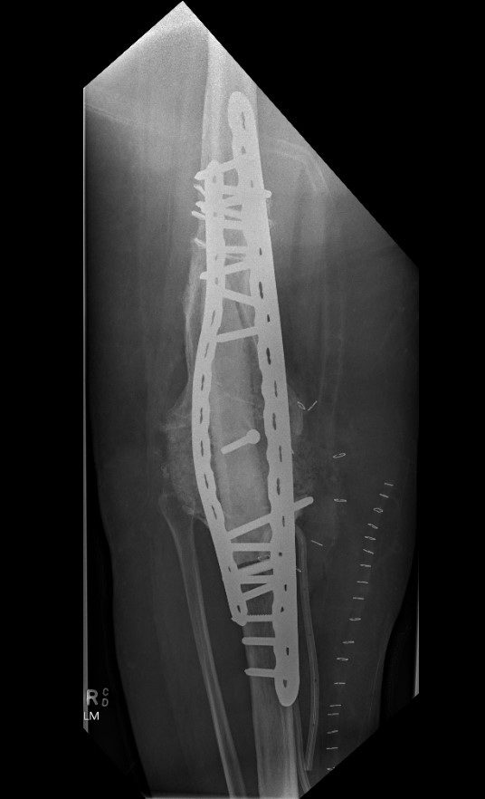 Arthrodesis | The Bone School