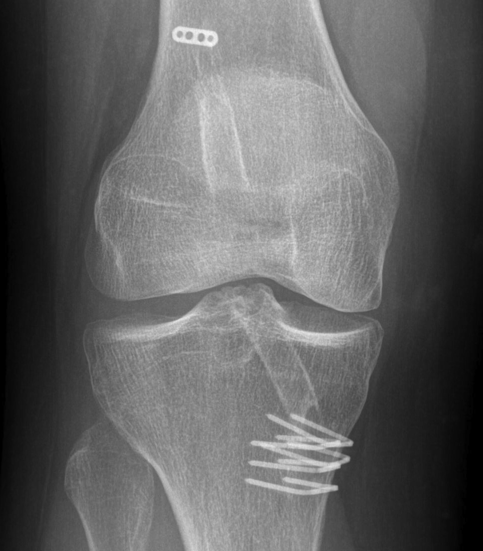 Revision ACL Cases | The Bone School