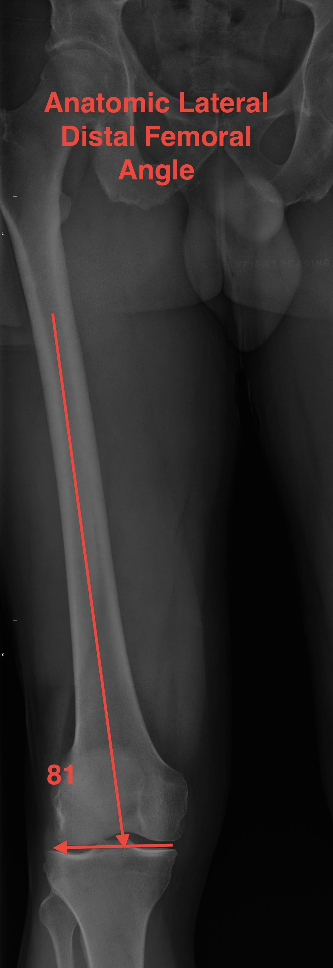 Lateral Distal Tibia Angle | Distal Tibia Valgus Cuts – FVOSE