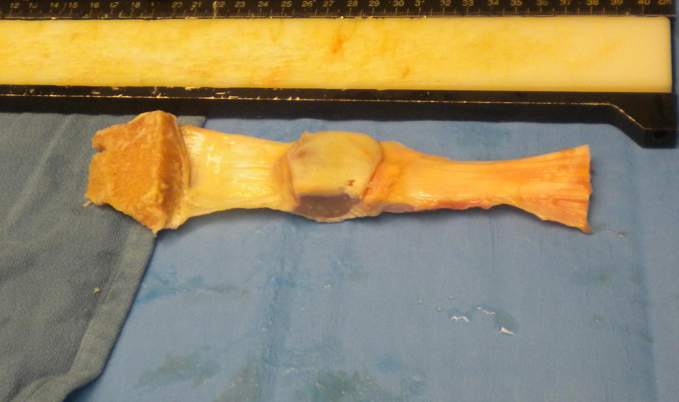 BPTB Allograft | The Bone School
