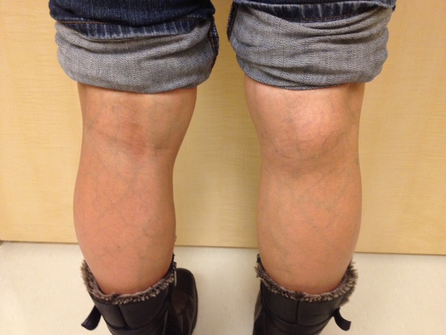 Knee Cysts & Bursa | The Bone School