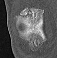 Bipartite Patella | The Bone School