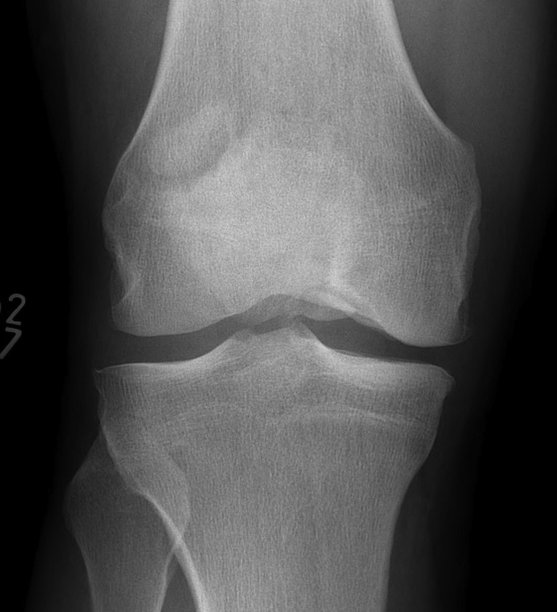 Bipartite Patella | The Bone School