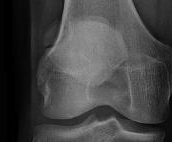 Bipartite Patella | The Bone School
