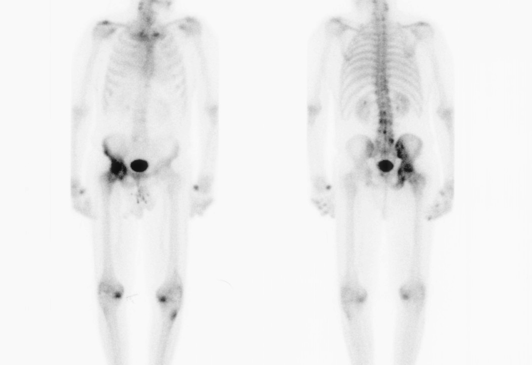 Bone scans | The Bone School