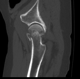 Femoral Head Fractures | The Bone School