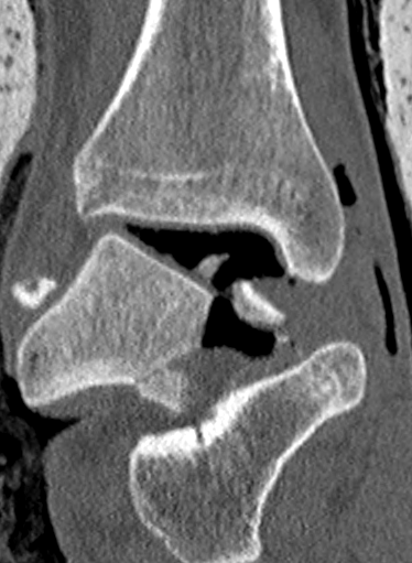 Talar body fracture | The Bone School