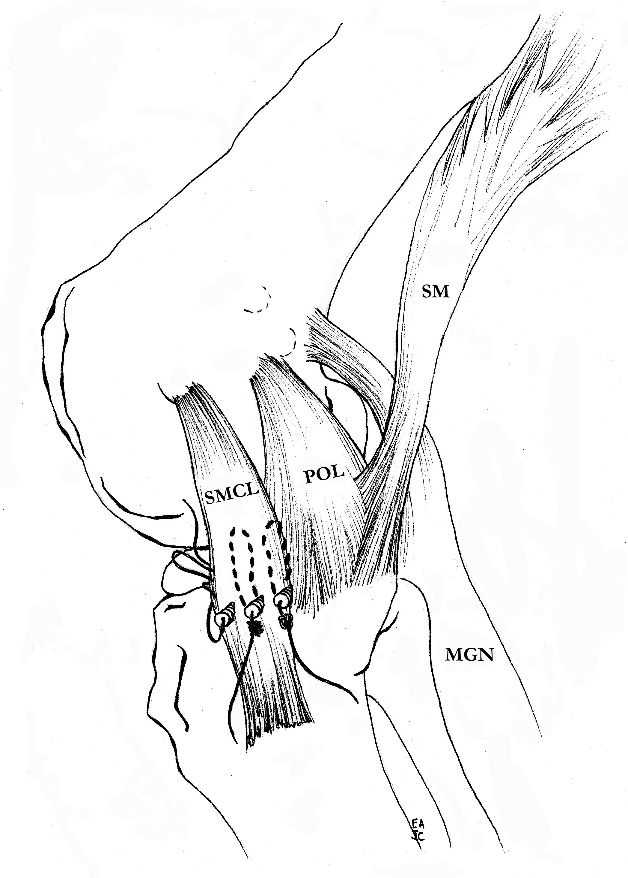 MCL and Posteromedial Corner | The Bone School