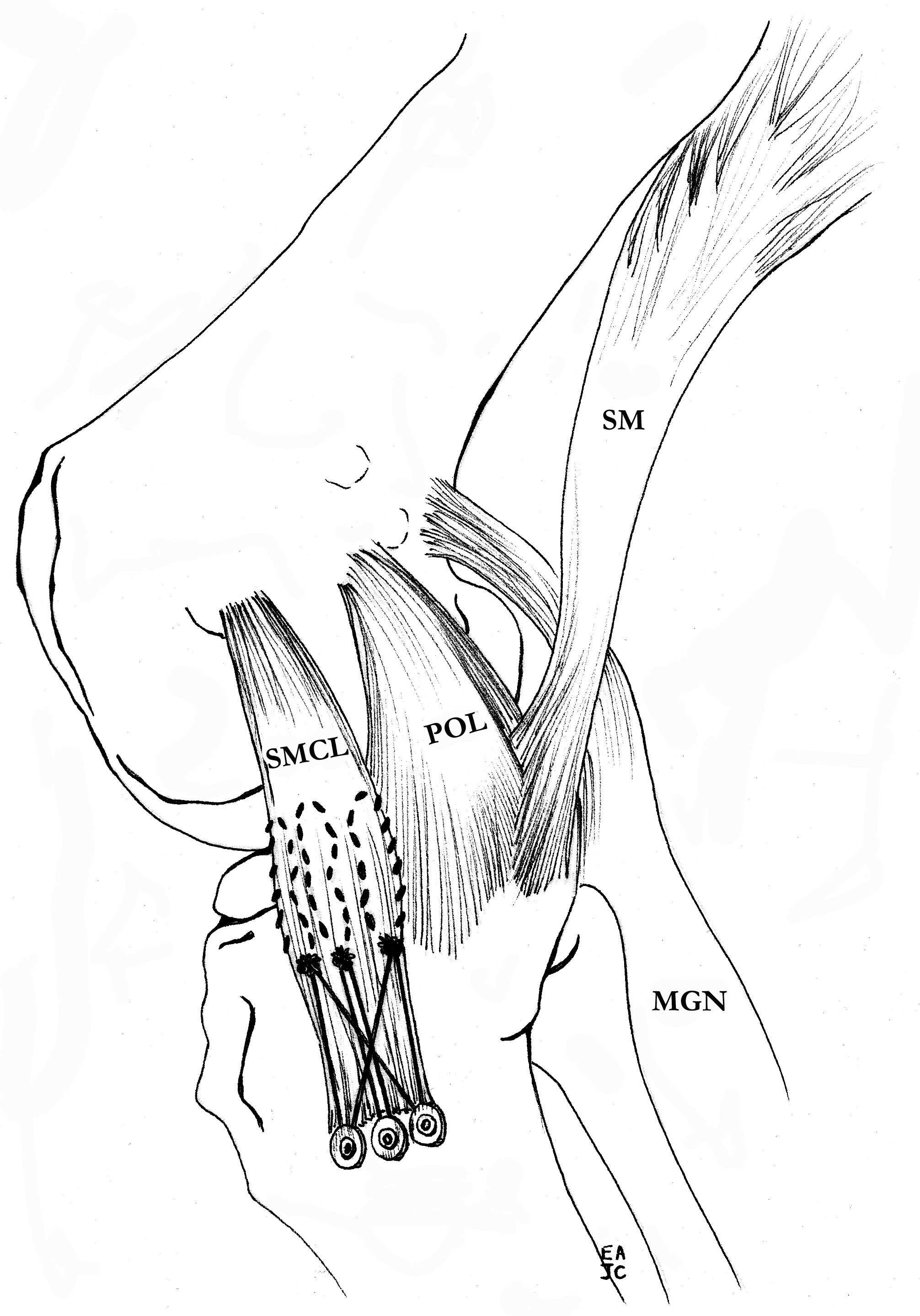 MCL and Posteromedial Corner | The Bone School