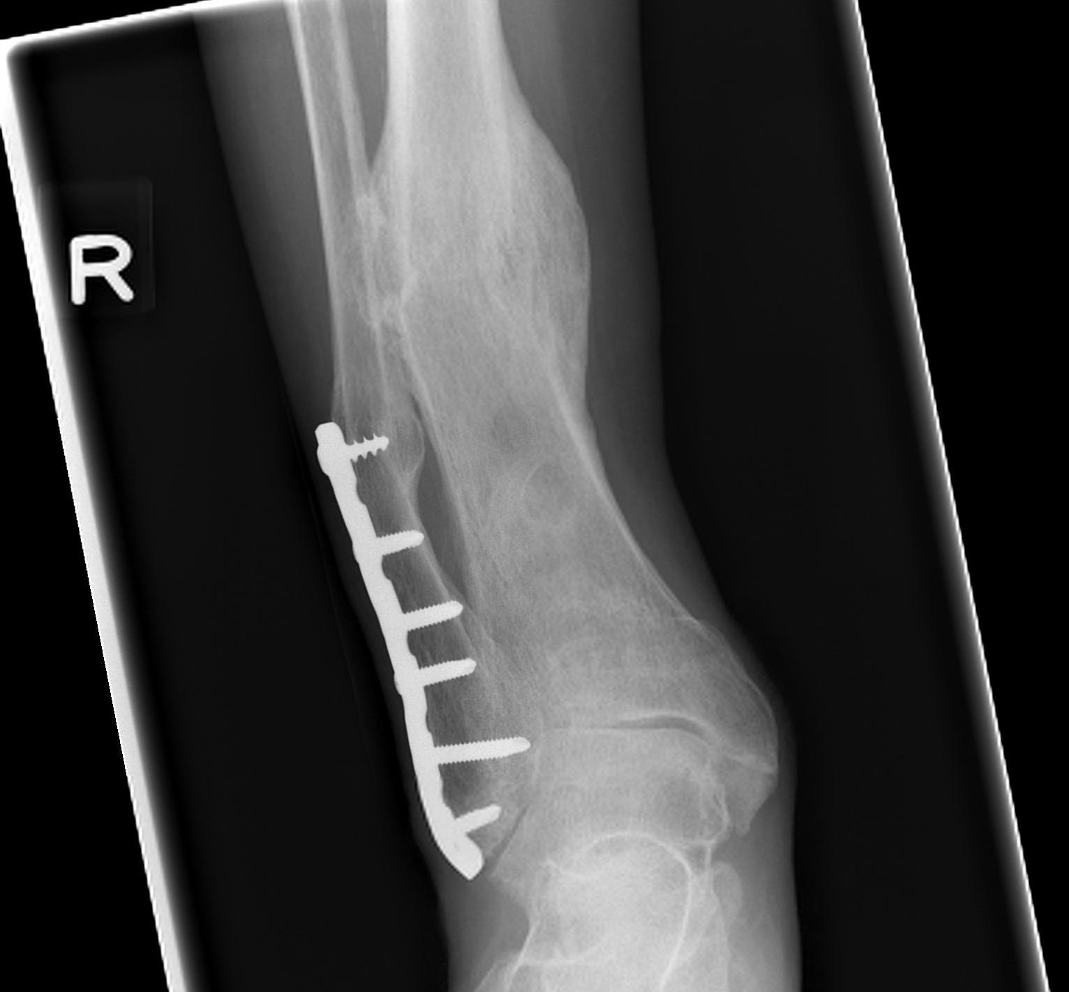 Distal Tibial Fractures | The Bone School