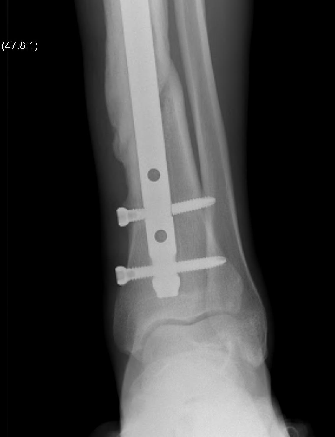 Distal Tibial Fractures | The Bone School
