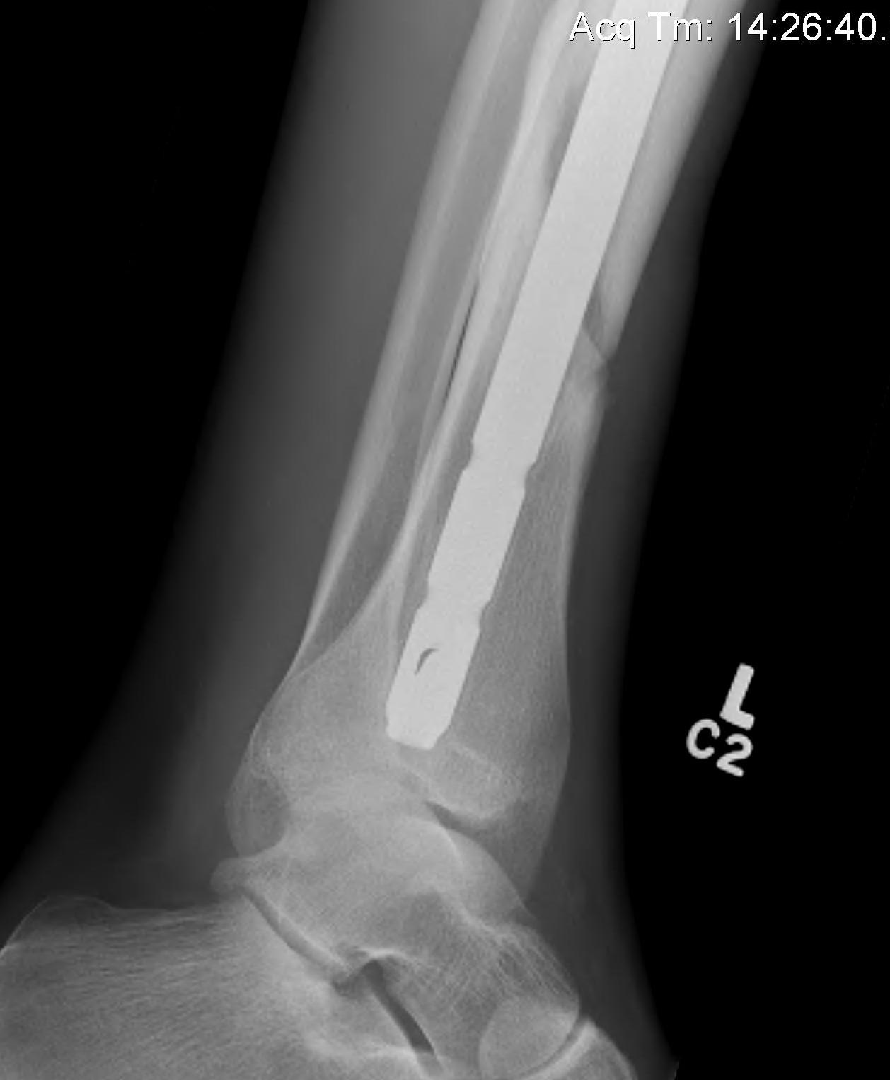 Distal Tibial Fractures | The Bone School