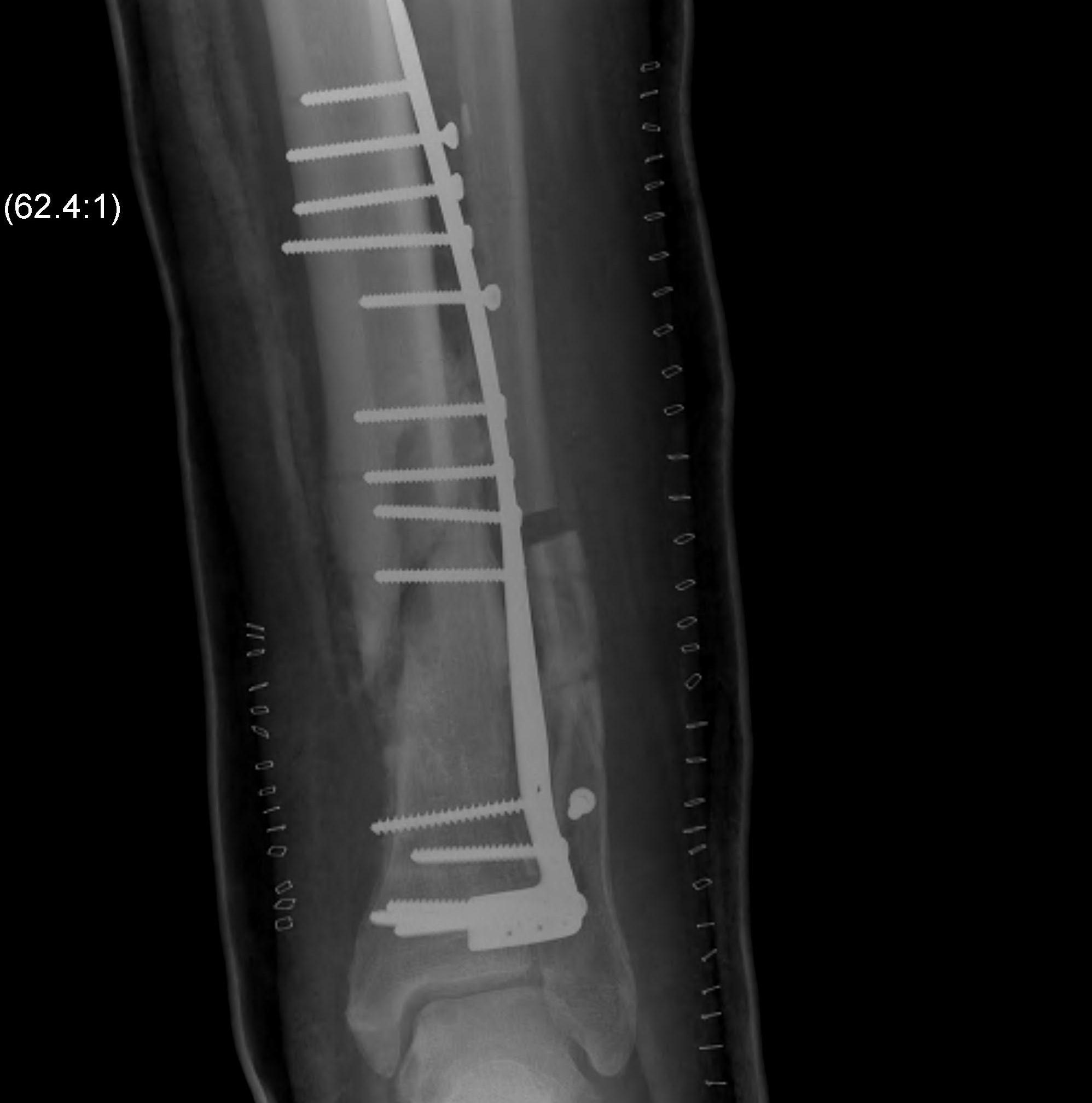 Distal Tibial Fractures | The Bone School