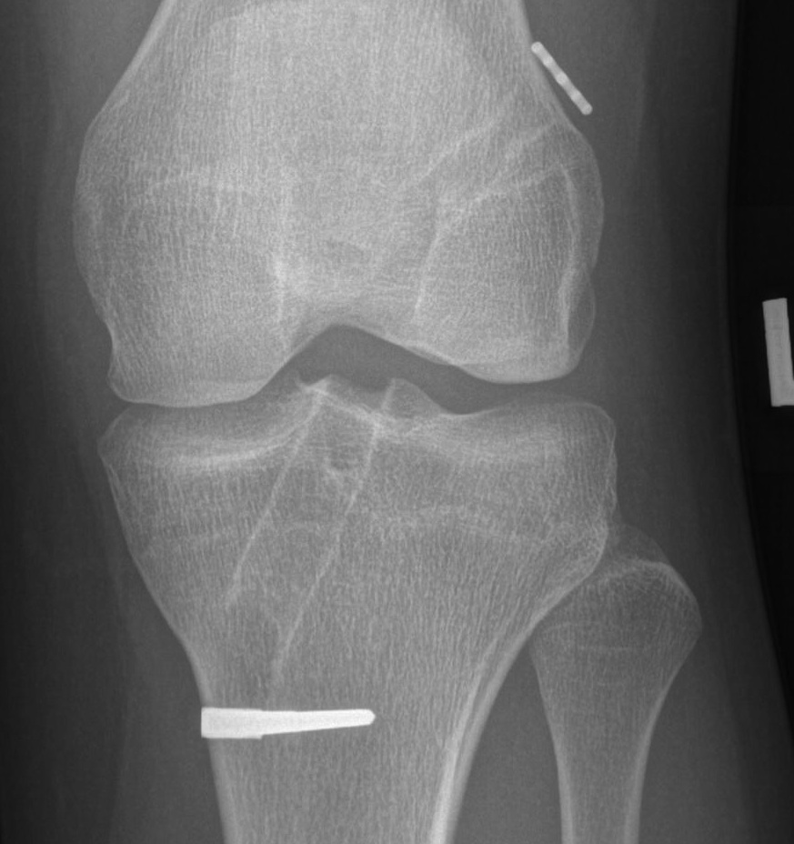Revision ACL Cases | The Bone School