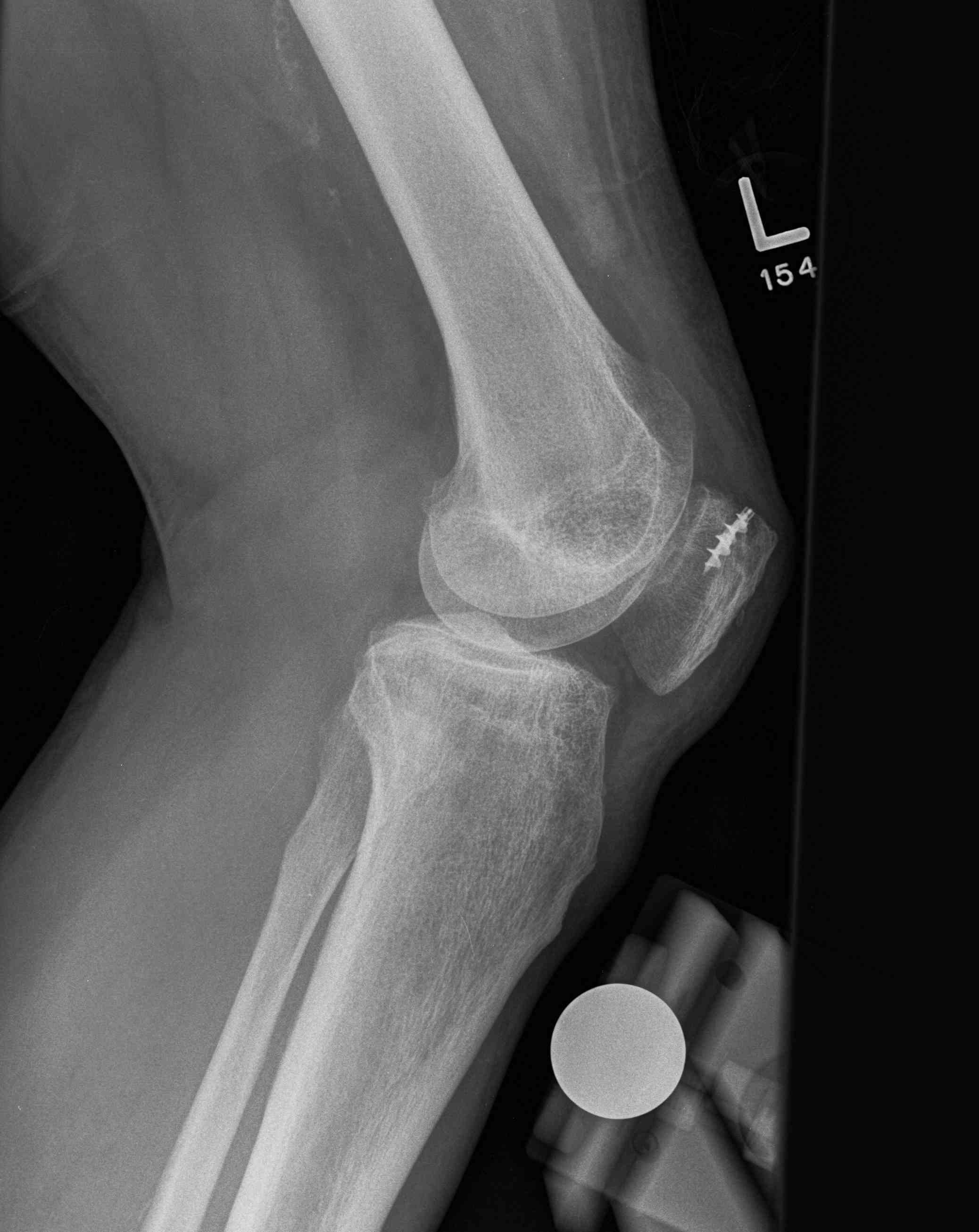 Quadriceps Tendon Rupture | The Bone School