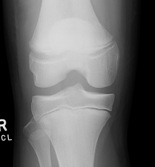 Distal Femur Epiphysis