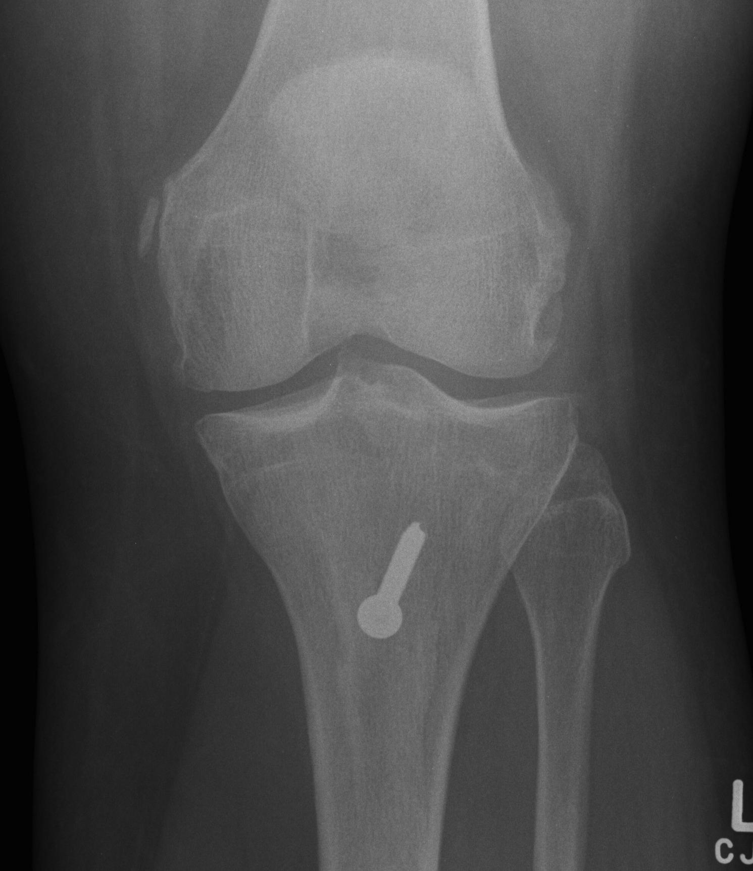 PFJ osteoarthritis | The Bone School