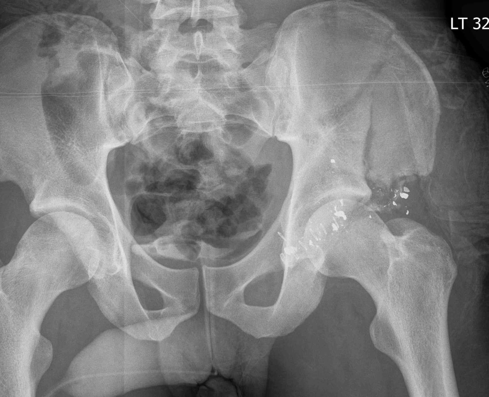 Gunshot Wounds | The Bone School