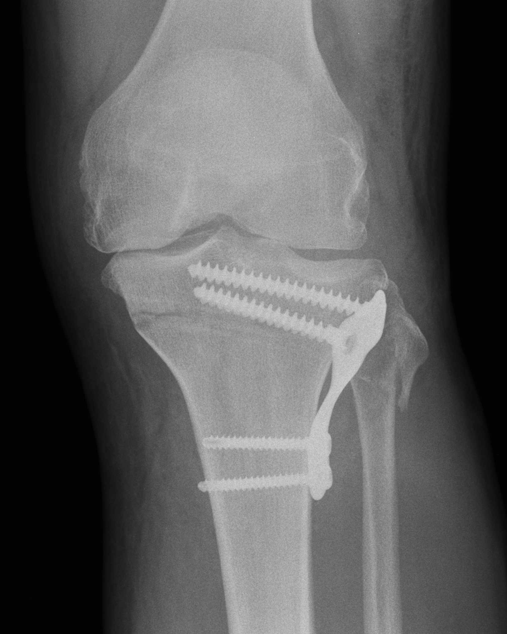 Lateral Closing Wedge HTO | The Bone School