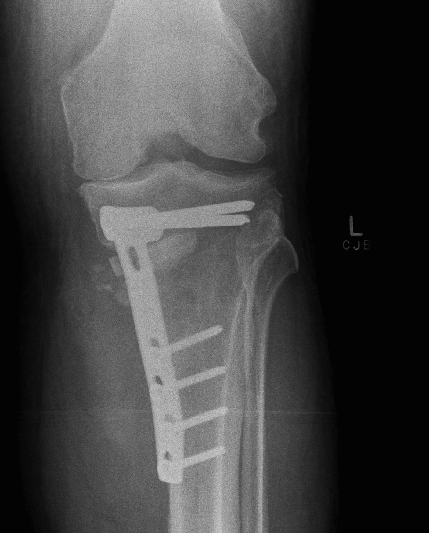 Technique Opening Wedge | The Bone School