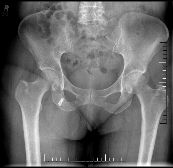 Proximal hamstring avulsions | The Bone School
