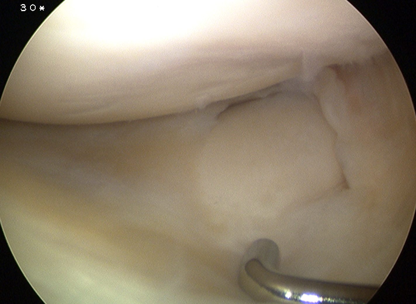 Discoid Meniscus | The Bone School