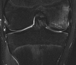 osteochondral fragment | The Bone School