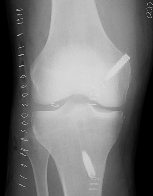 LARS PCL Reconstruction Technique | The Bone School