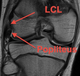 Popliteofibular Ligament Mri Imaging Of The Posterolateral Corner Of