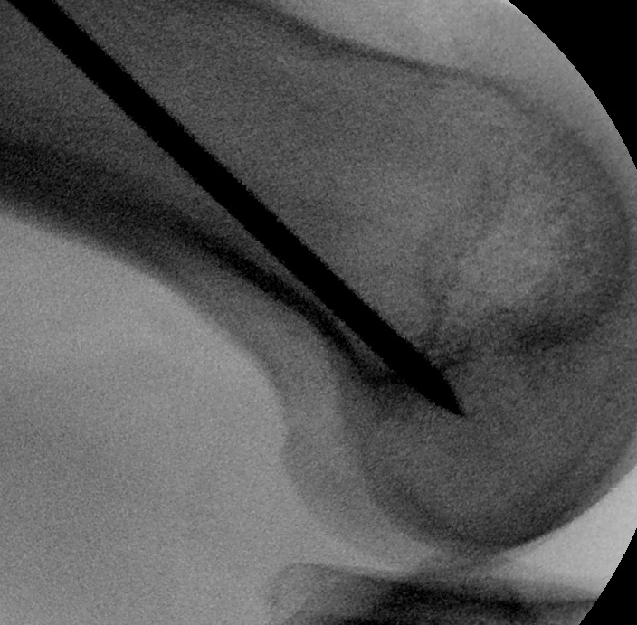 Lars ACL | The Bone School