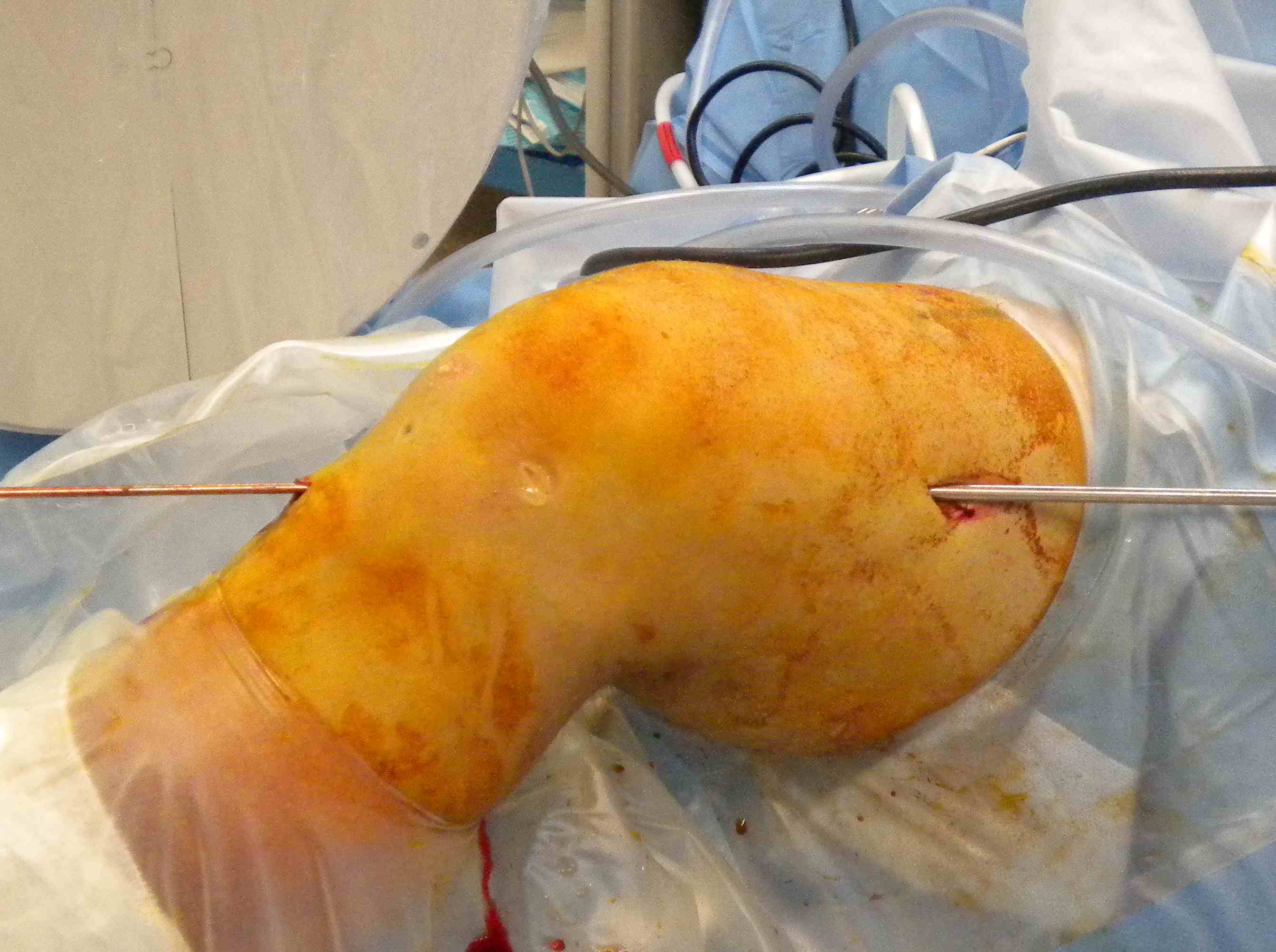 Lars ACL | The Bone School