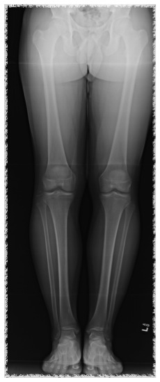 Chronic PLC Management | The Bone School