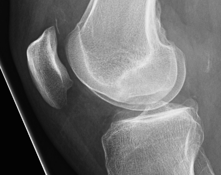 Acute Patella Dislocation | The Bone School