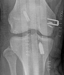MCL and Posteromedial Corner | The Bone School
