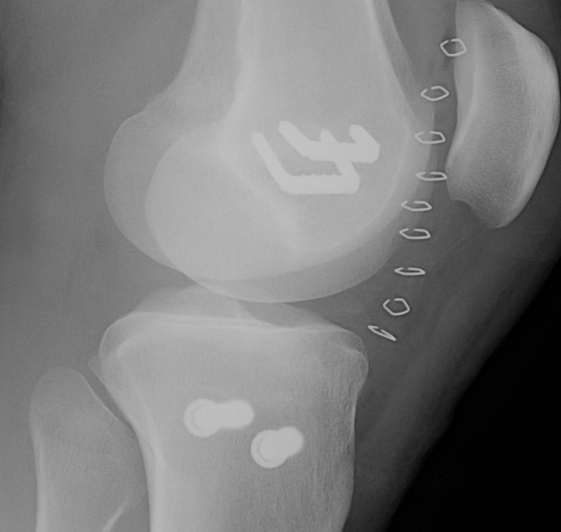 MCL and Posteromedial Corner | The Bone School
