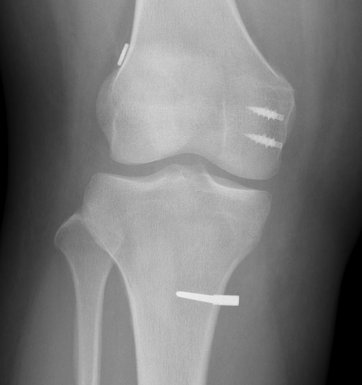 MCL and Posteromedial Corner | The Bone School