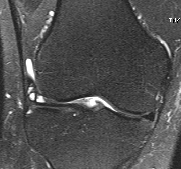 Meniscal Cysts | The Bone School