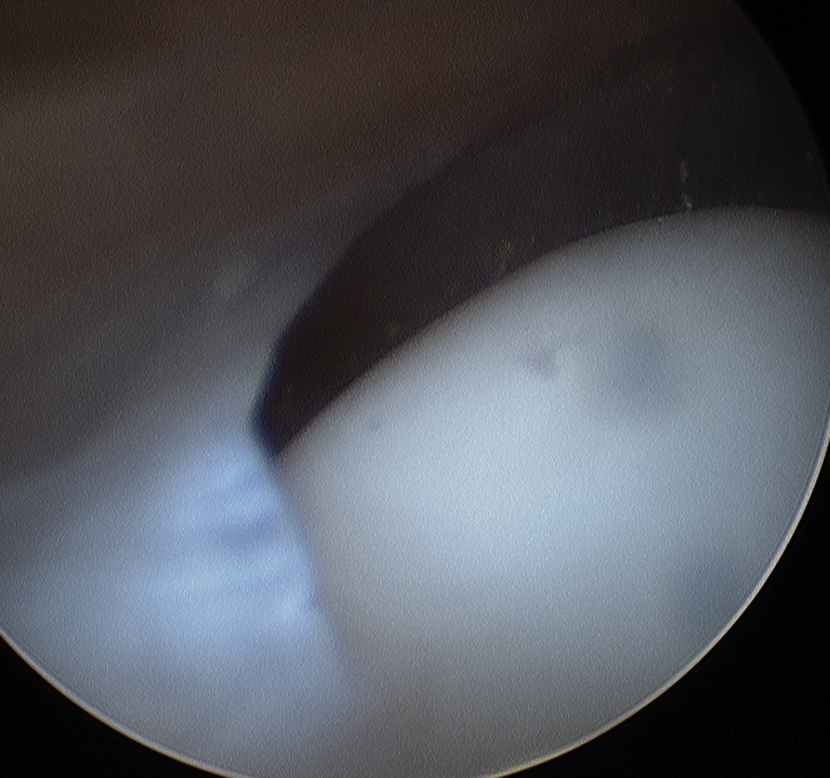 Knee Plica | The Bone School
