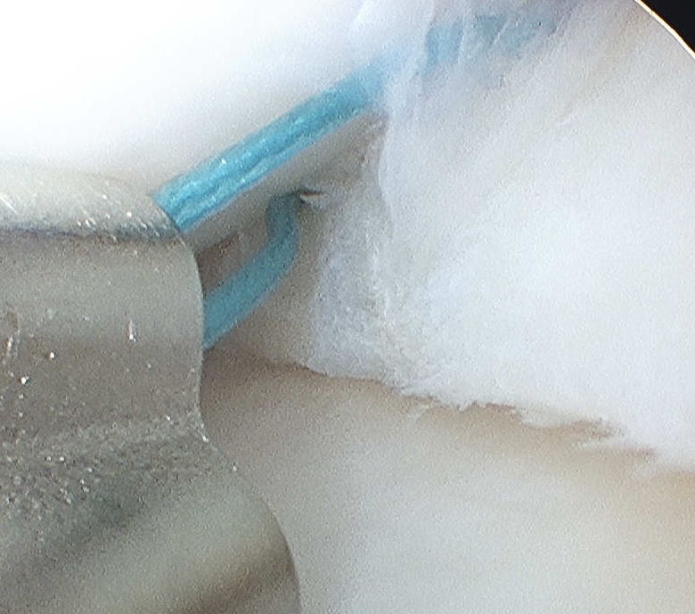 Meniscal Repair | The Bone School